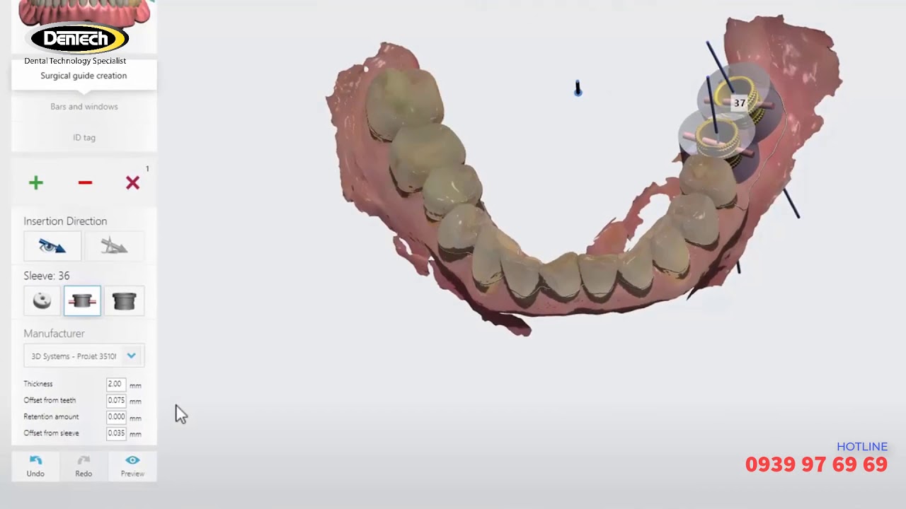 3Shape - Implant Studio 2017 Surgical Guide - YouTube