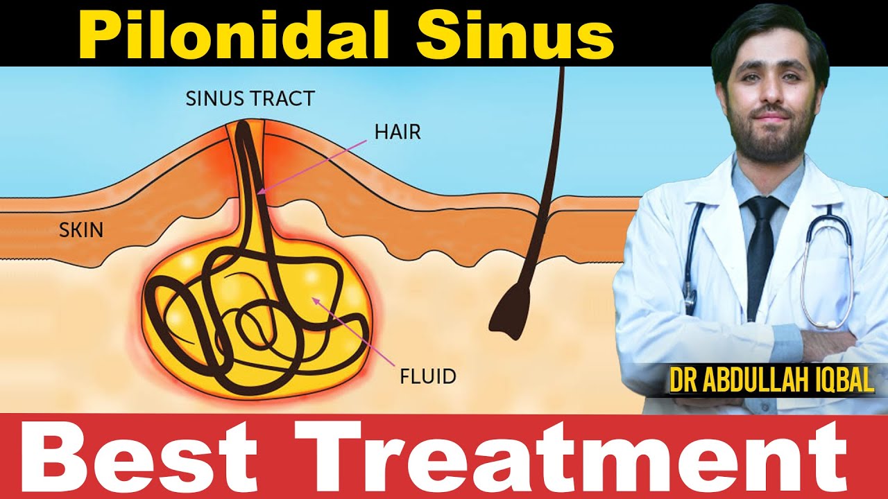 Pilonidal Sinus Kya Hai | Tailbone Infection Treatment | Kamar Niche ...