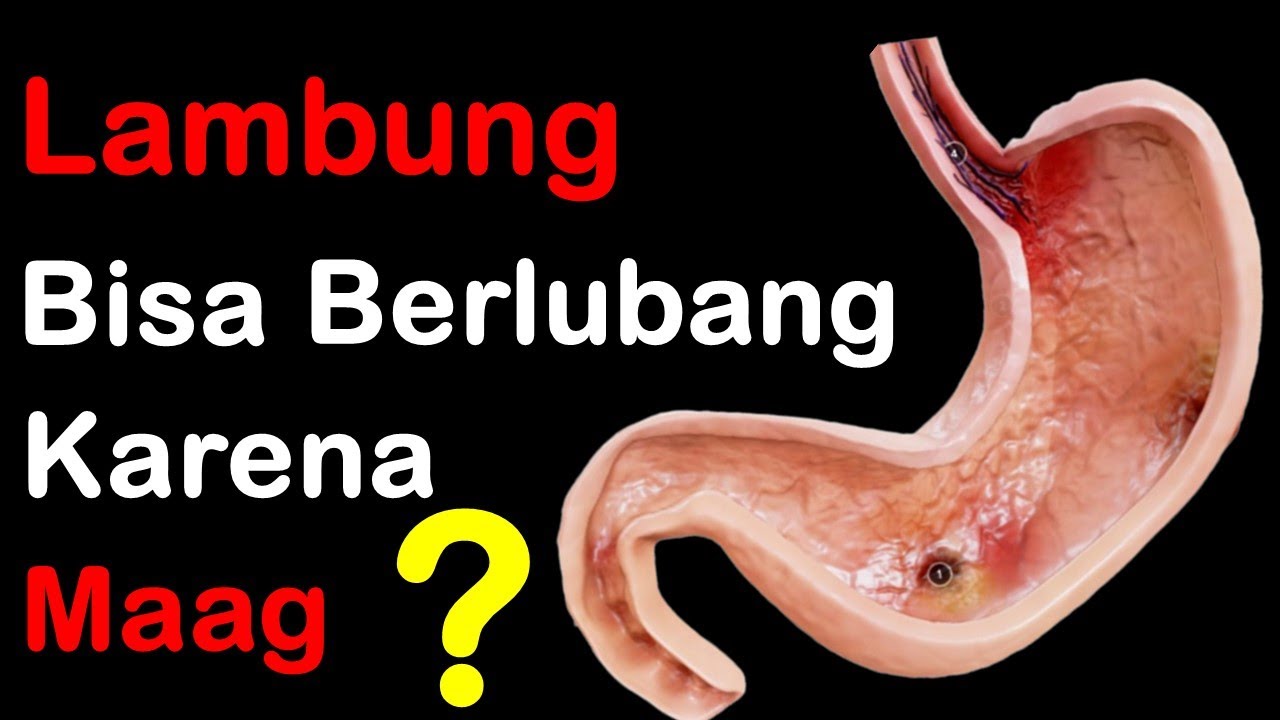 Lambung Bisa Berlubang Karena Penyakit Maag ????? - YouTube