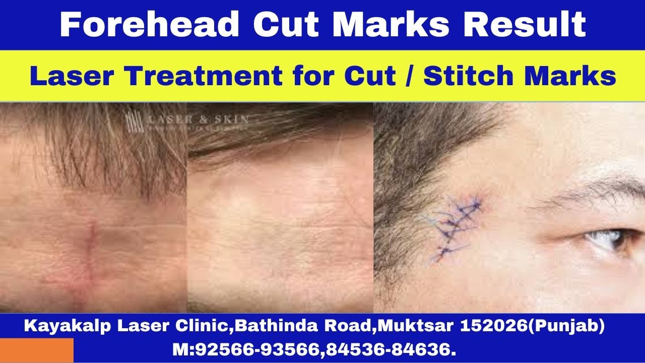 Forehead Cut Marks Result | Laser Treatment for Cut / Stitch Marks ...