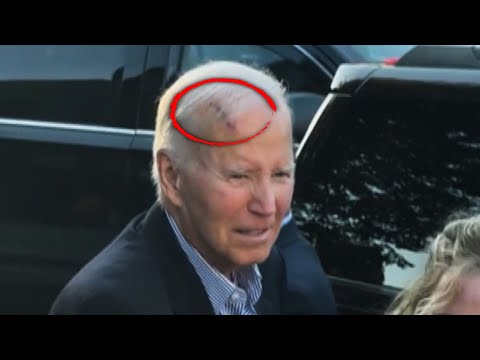 Joe Biden Appears to Have Large Gash on Head