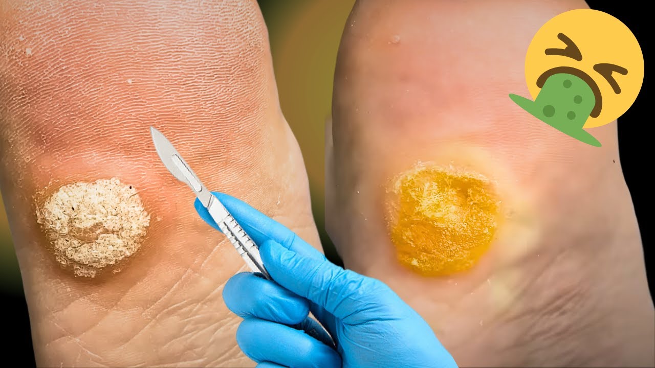 The biggest wart ever seen! 😱😱 - YouTube