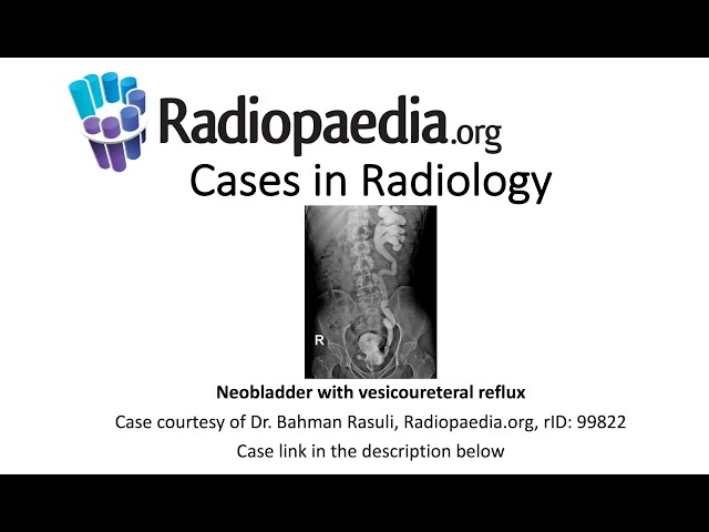 Neobladder Ultrasound