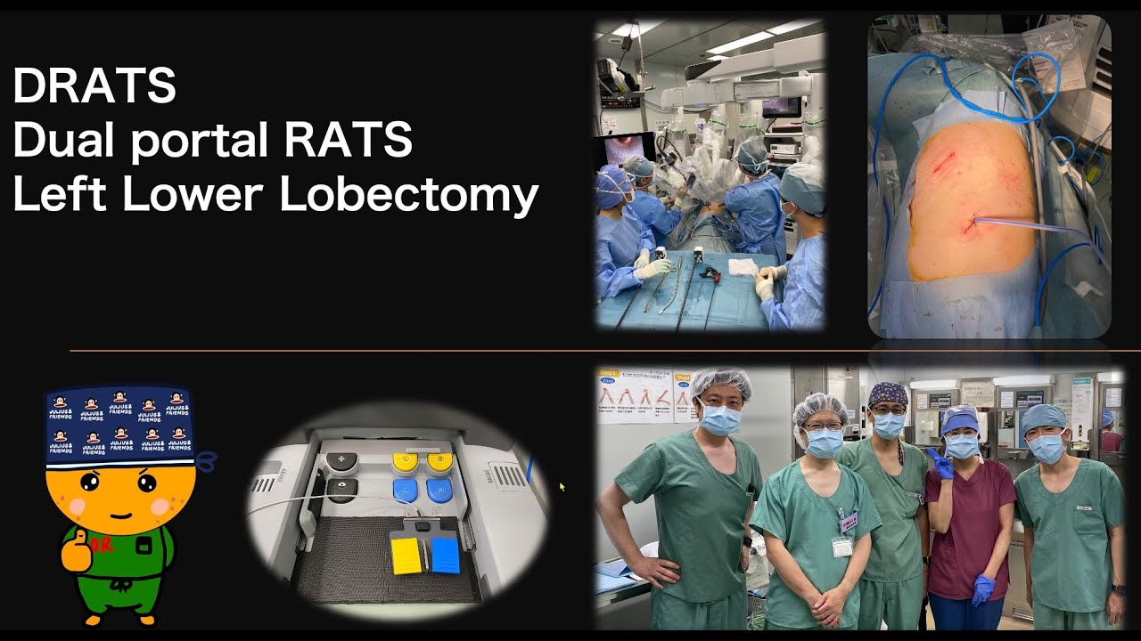 90】DRATS; Dual portal RATS, left lower lobectomy - YouTube