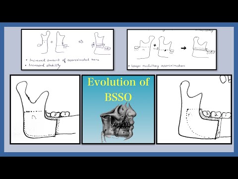 Kieferorthopädische Chirurgie: Modifikationen der BSSO | Dr. Manish Tiwari | Vorträge zur Oralchi...