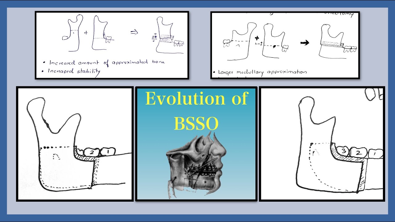 Orthognathic surgery: modifications of BSSO | Dr Manish Tiwari | oral ...