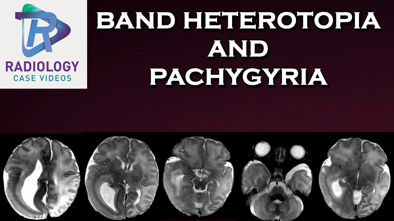 Band heterotopia and Pachygyria - YouTube