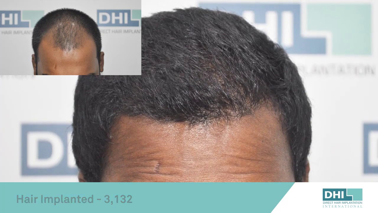 Hair Transplant Result In Delhi Using DHI (Direct Hair Implantation ...