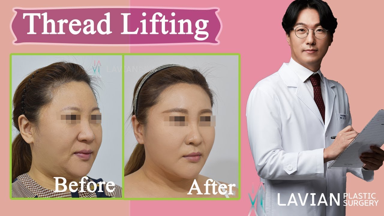 Transform to Natural and Young face with thread lifting in Korea Top ...