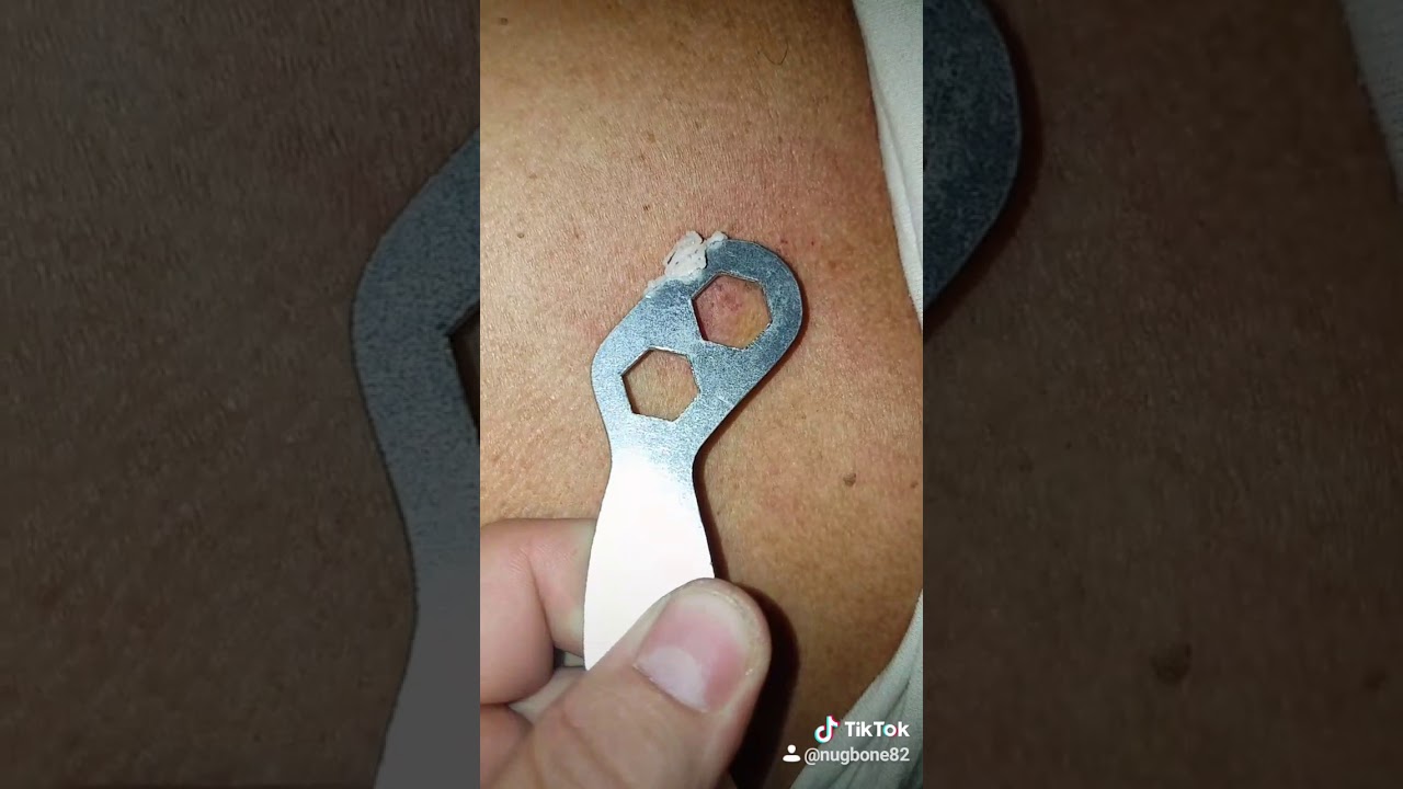 Popping cyst part 3 - YouTube