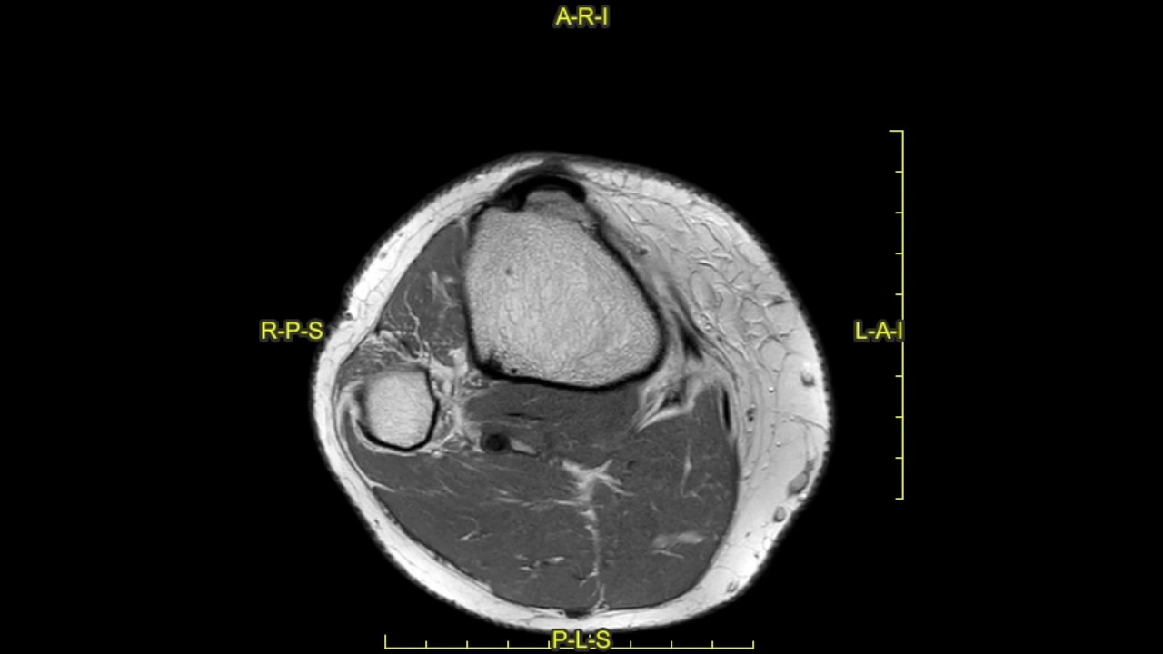 Medial patello-femoral ligament tear - complete MRI examination - YouTube