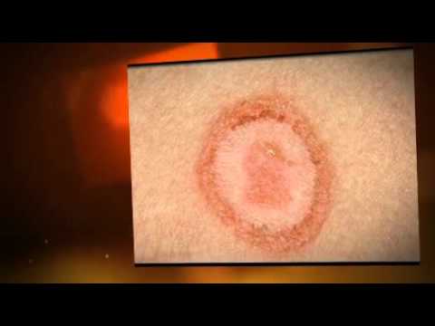 How To Get Rid Of Ring Worm Fast - YouTube