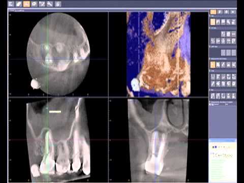 How to read a CBCT (Cone Beam Computed Tomography) Scan - YouTube