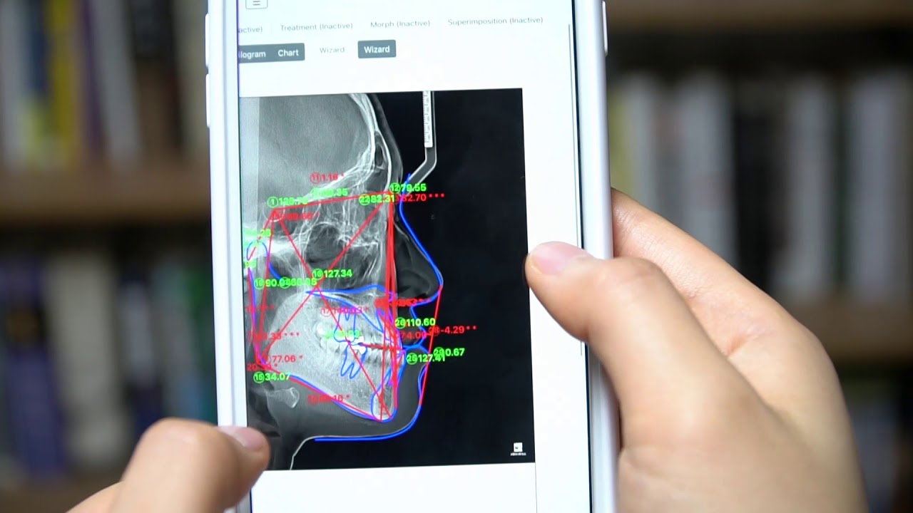 WebCeph: AI(Artificial intelligence) web-based orthodontic analysis ...