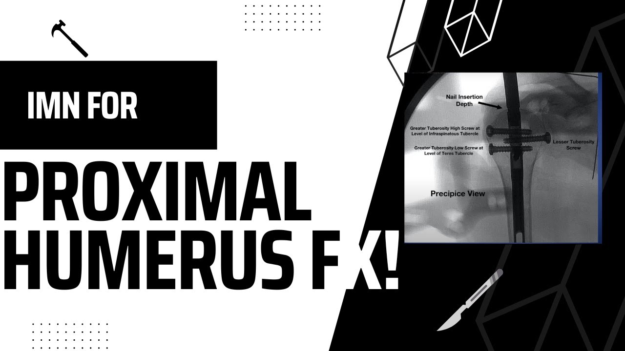 Intramedullary Nailing of Proximal Humerus Fractures w/ Dr. Sears - YouTube