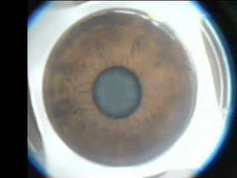 Hyperopic LASIK the introduction of Topography-guided ablation ...