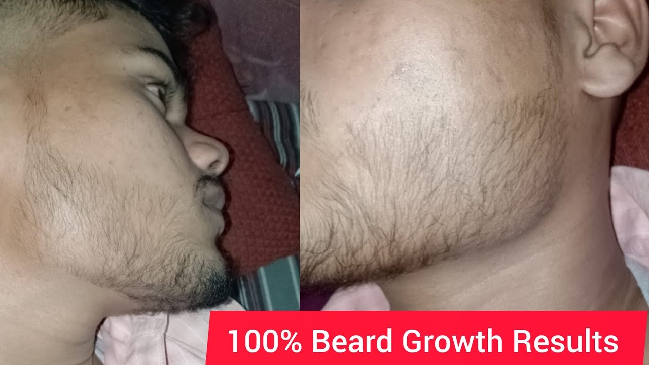 Beard Growth Result of Two person / Dadhi Nahi A Rahi / Patchy Beard ...