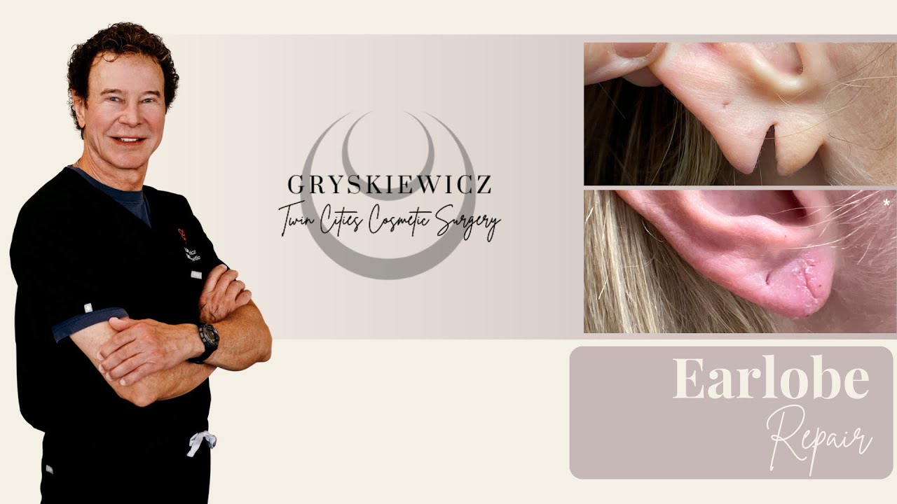 Earlobe Repair by Dr. Joe - YouTube