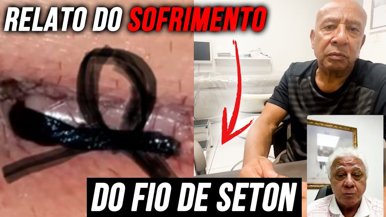 Como Retirar O Fio De Seton - BRAINCP