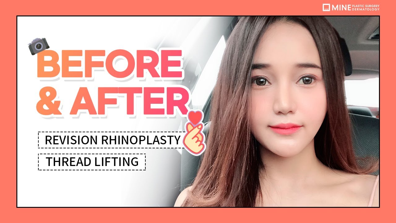[BEFORE & AFTER📸] Revision Rhinoplasty, Thread Lifting | MINE Plastic ...