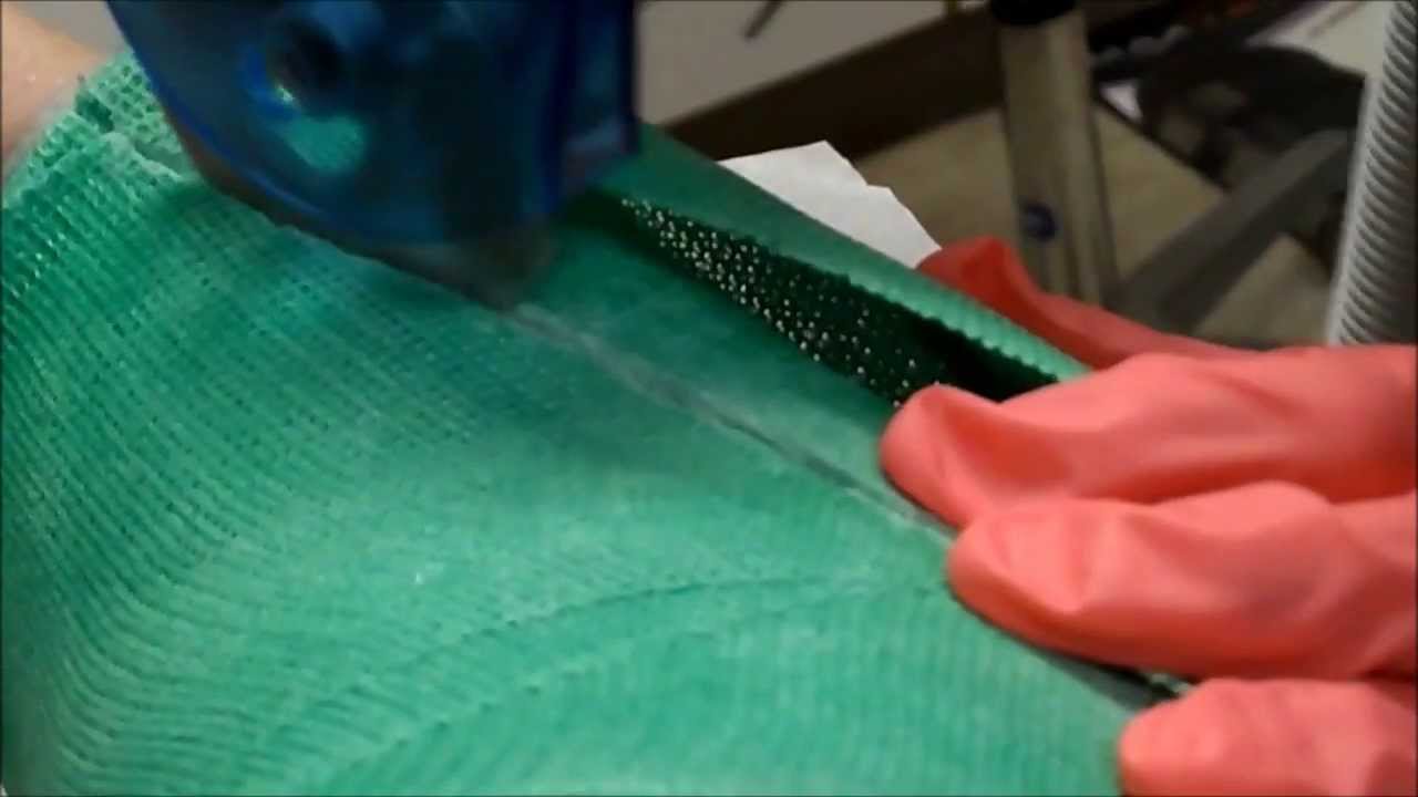 cast removal bilateral fibular fractures - YouTube