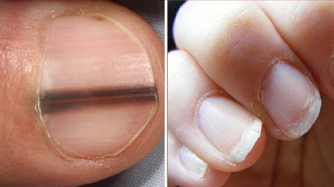 6 Things That Your Nails Say About Your Health - YouTube