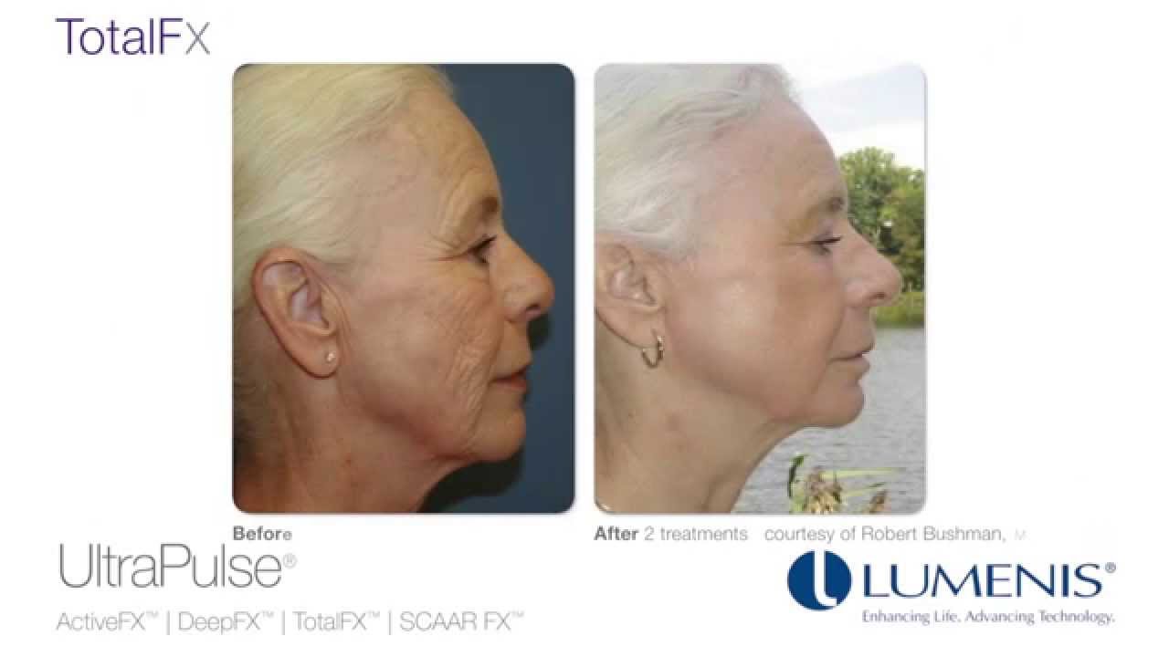 LaserMed: Aesthetic Laser Treatments on UltraPulse - YouTube