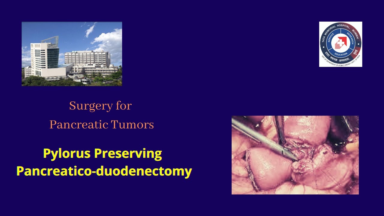 Pylorus Preserving Pancreatico duodenectomy - YouTube