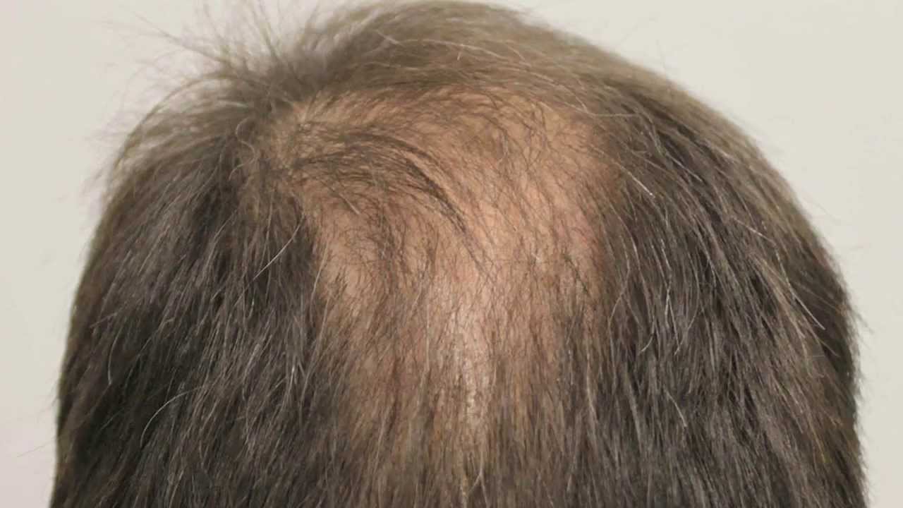 FUE by Dr Reddy - Restoration of crown - YouTube