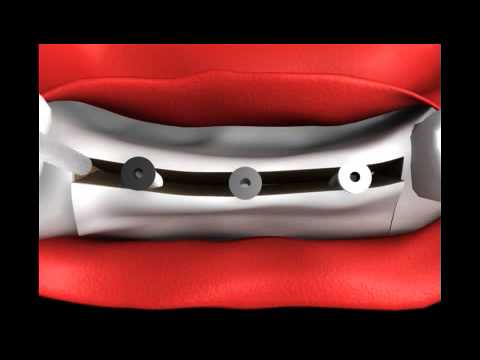 bone split - YouTube