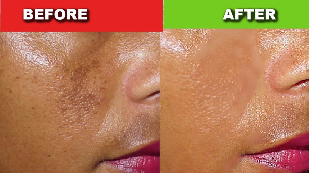 The Secret is Out! Clear Hyperpigmentation From Face, Neck, Dark Knees ...