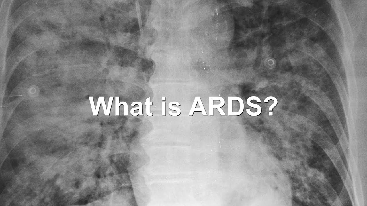 Developing New Treatments for ARDS, A Devastating Condition - YouTube