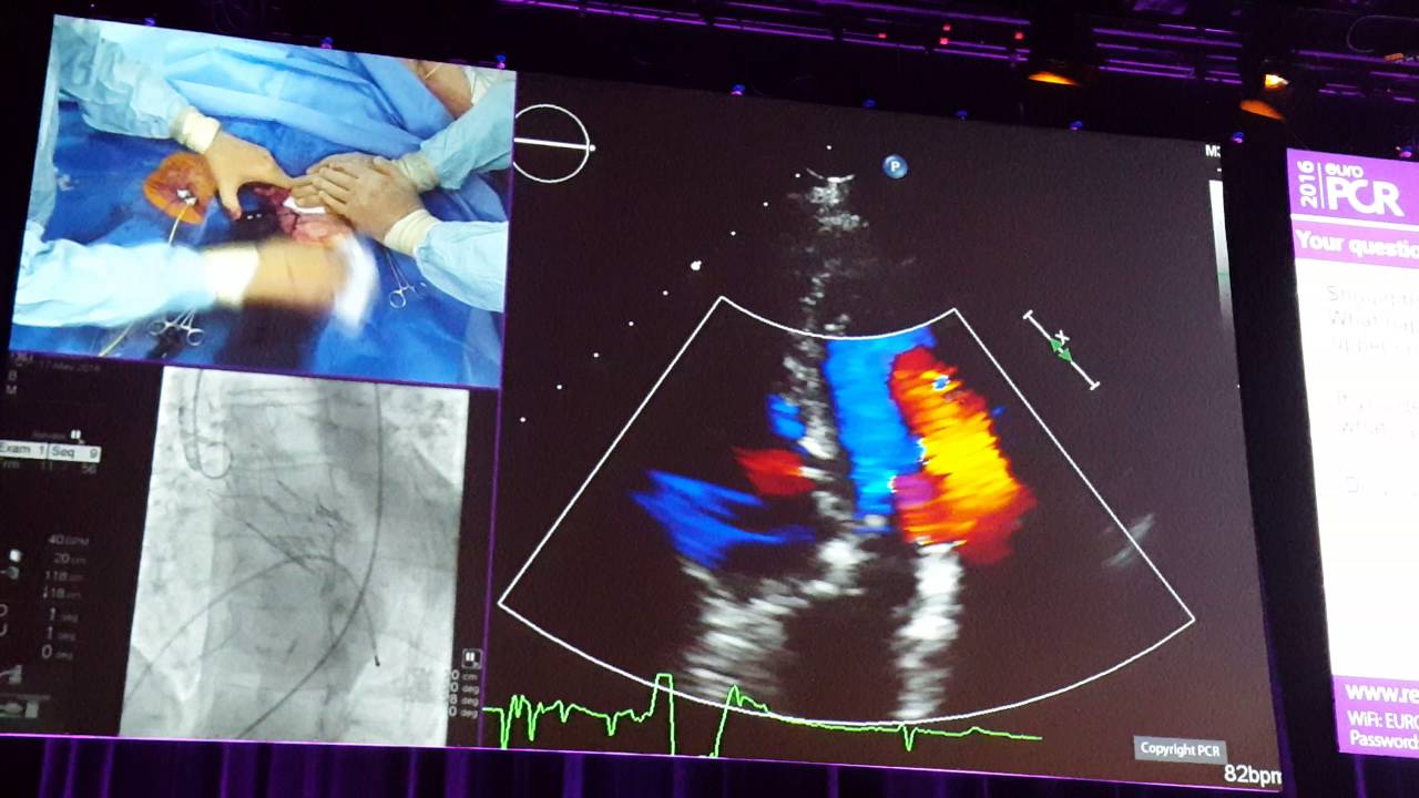 Multi access ACURATE neo TAVI system LIVE - EuroPCR 16 - Part 5 4K ...