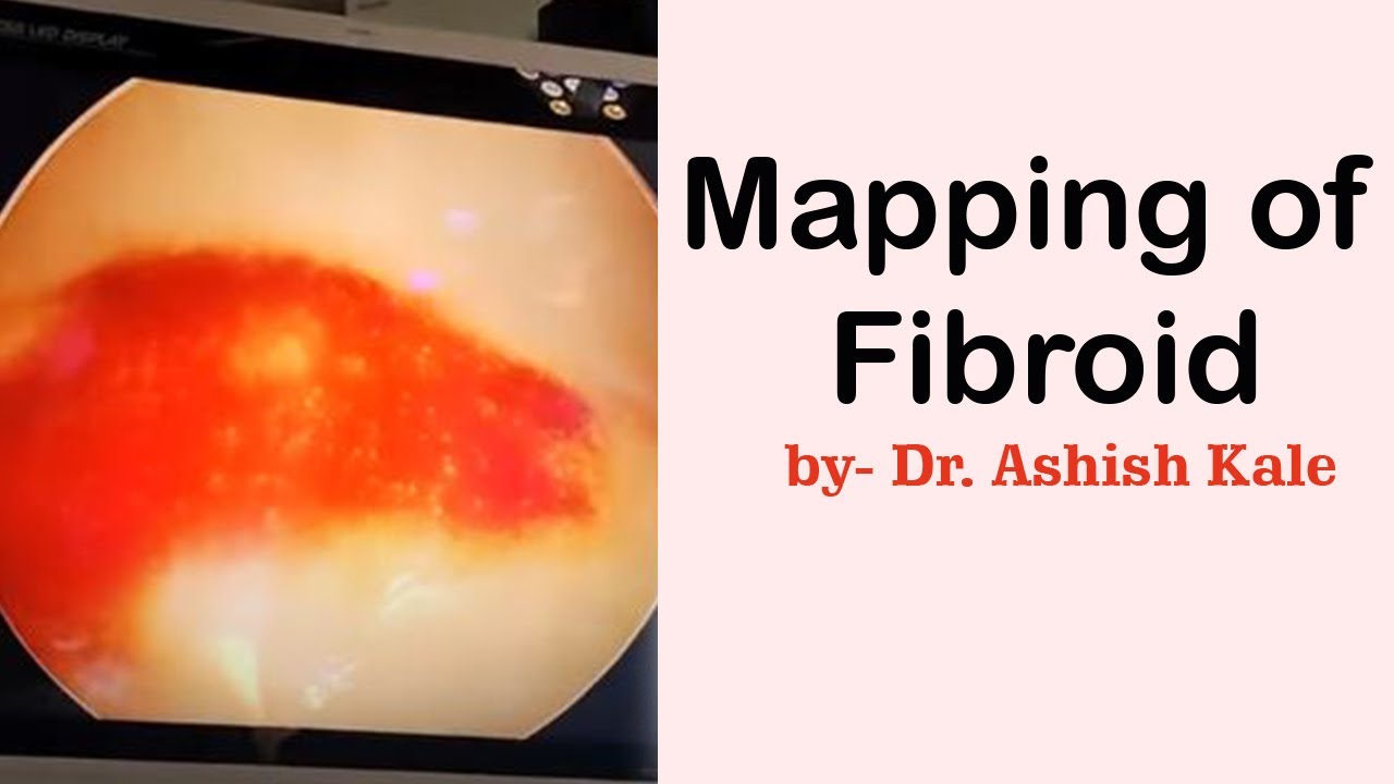 Mapping of fibroid by Dr Ashish Kale #importance of USG# hysteroscopic ...