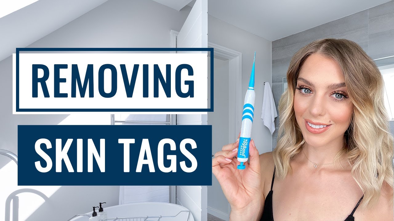 HOW TO REMOVE SKIN TAGS | Does TagBand Work? Skin tag removal tips ...