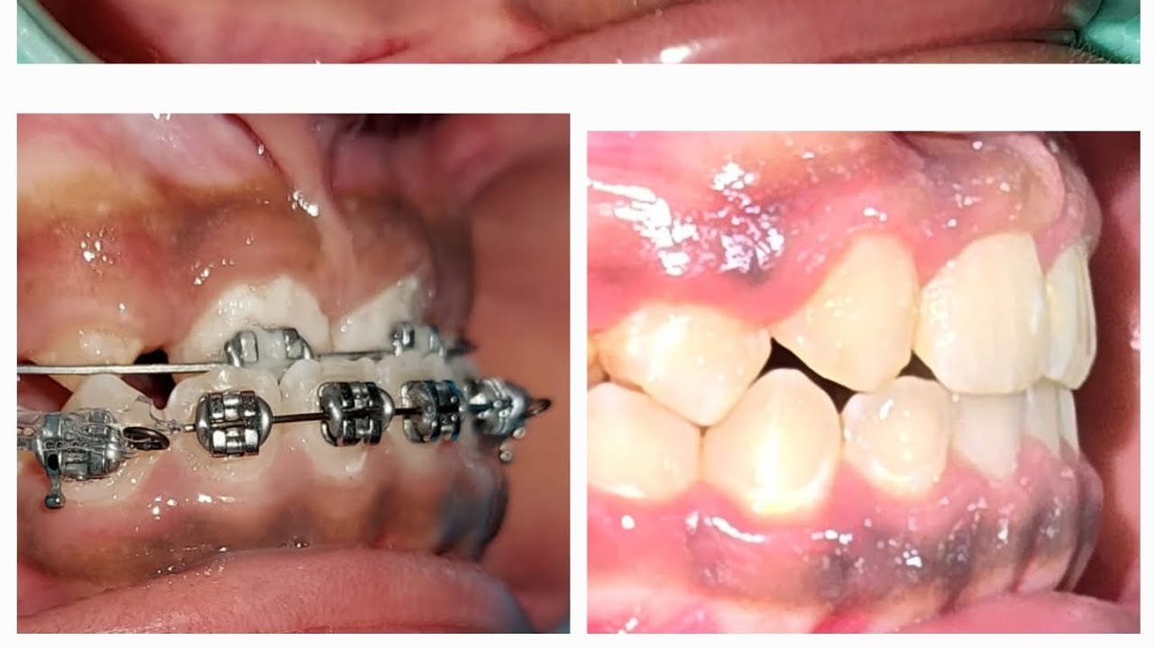 A case of Class III Malocclusion with Midface deficiency and Missing ...