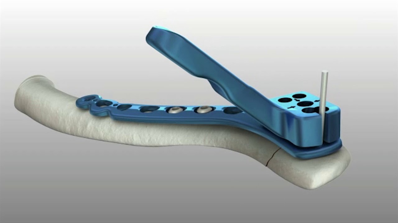 SHD90 01 A Locking Superior Distal Clavicle Plate Surgical Technique ...