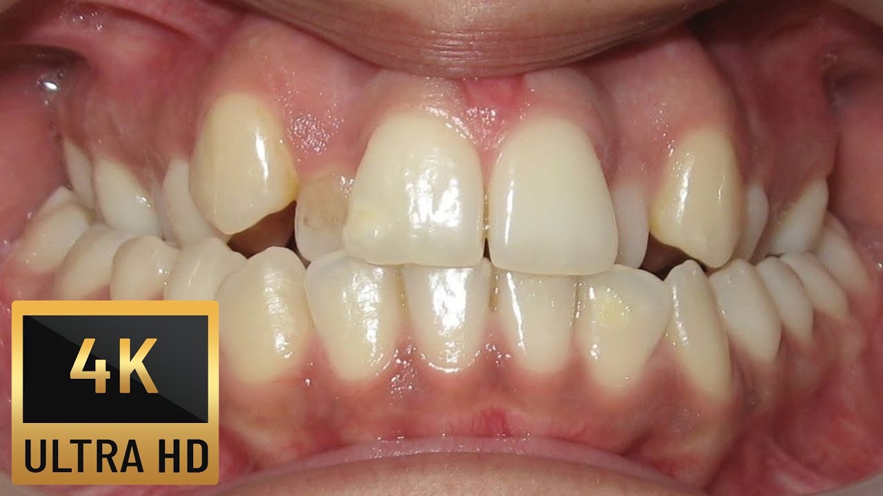 HOW #BRACES WORK #timelapse of Crossbite. Ectopic canines #4k - YouTube