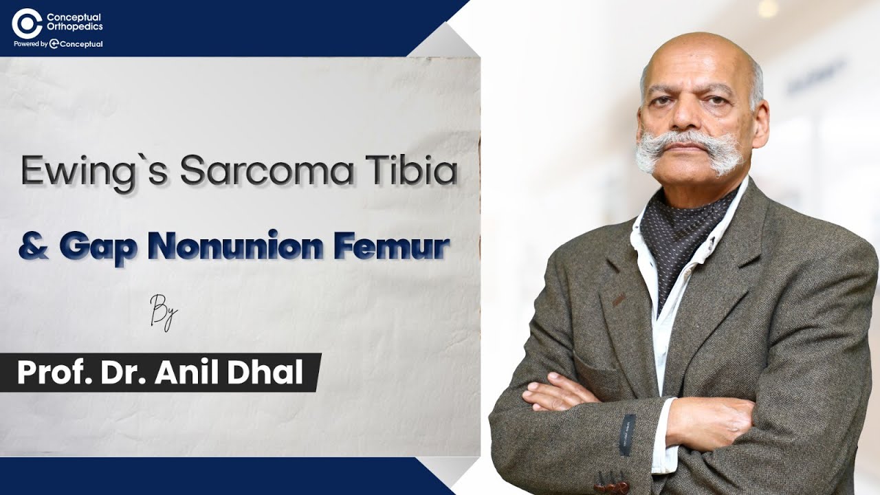 Ewing`s Sarcoma Tibia & Gap Nonunion Femur by Prof.Dr. Anil Dhal ...