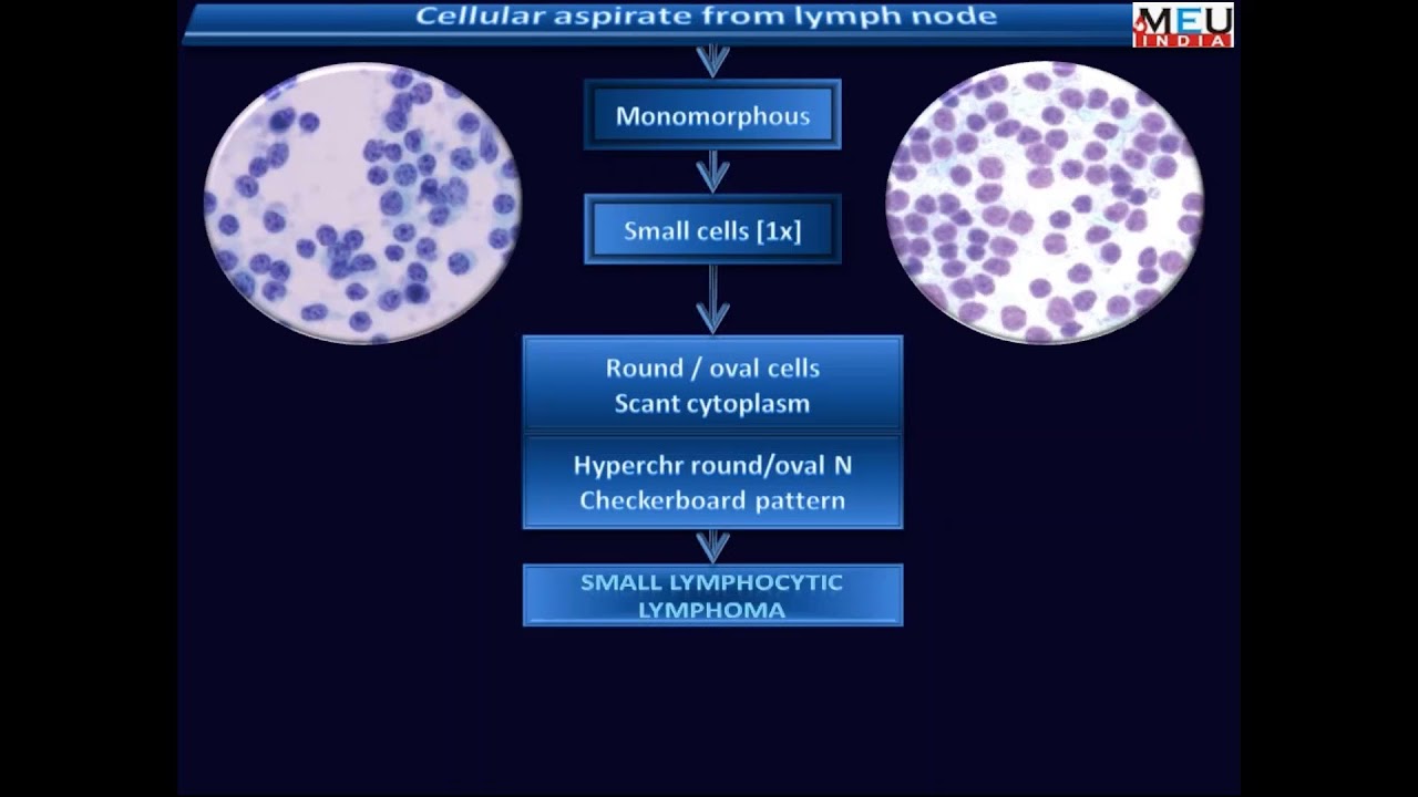 FNAC Lymph Node. - YouTube