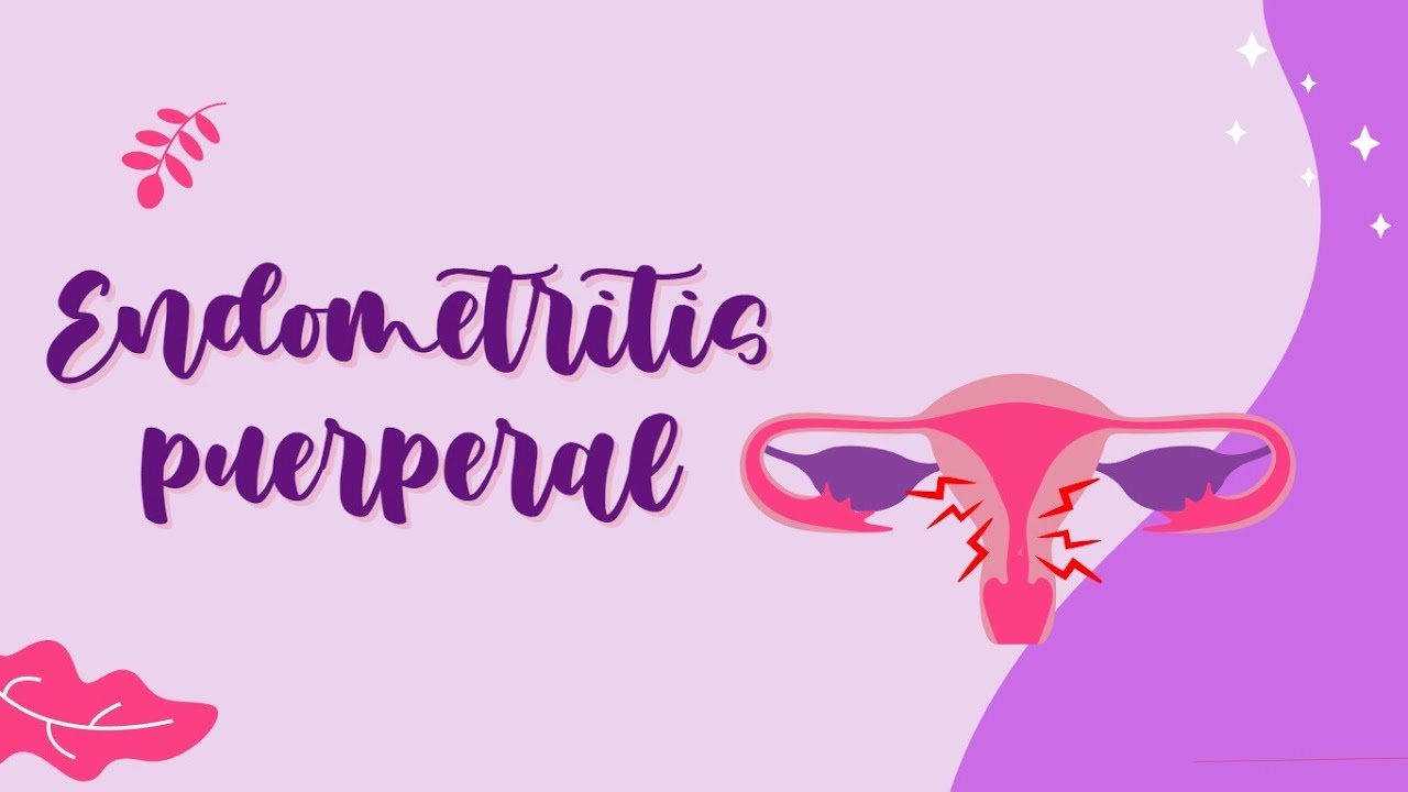 Endometritis puerperal - YouTube