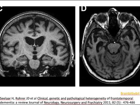 19. Frontotemporal dementia on MRI; FTLD, neurodegenerative, Tau ...