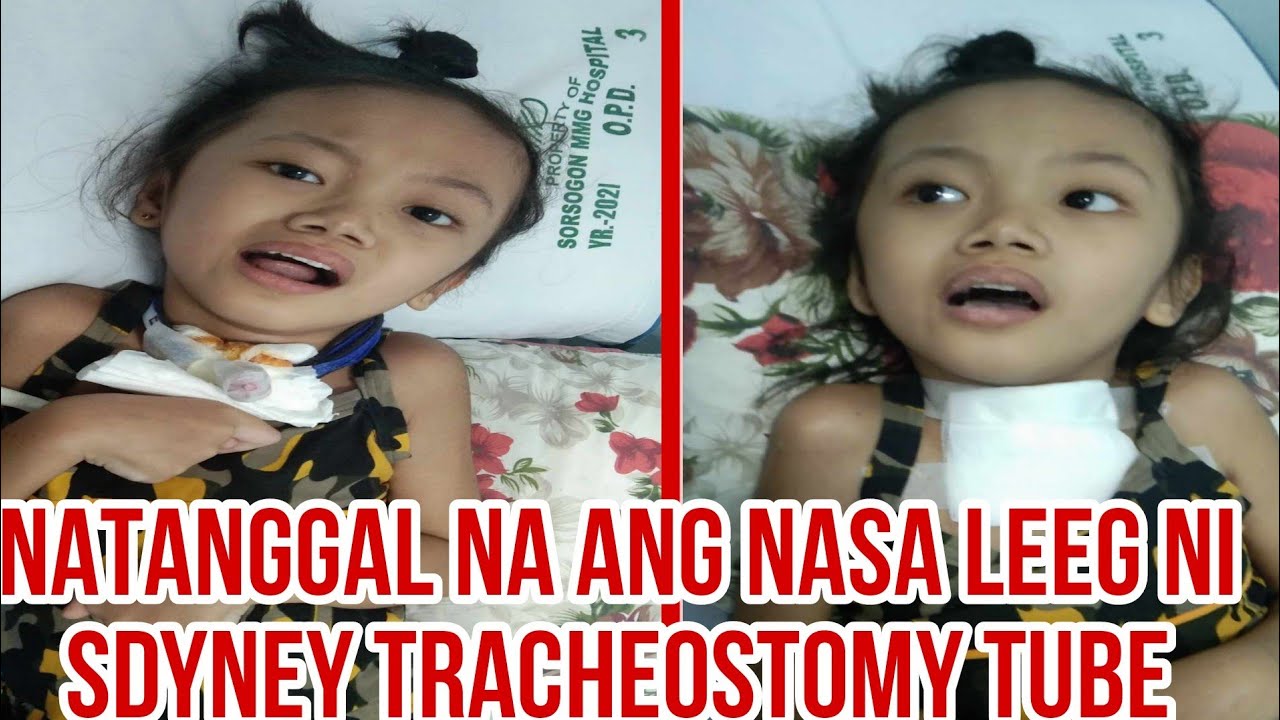 #part24 SDYNEY NATANGGAL NA ANG TRACHEOSTOMY TUBE SA LEEG AT MAY BOSES ...