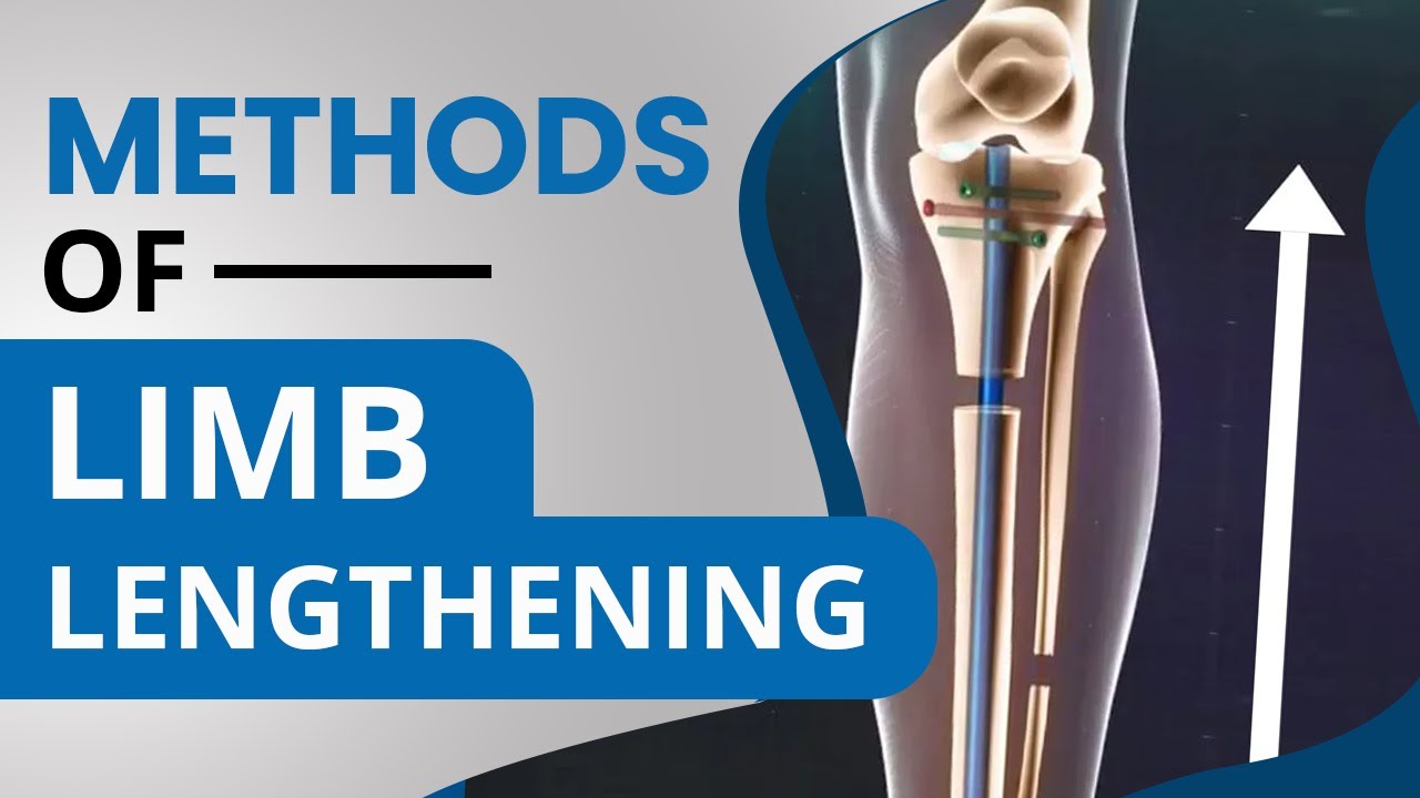 Methods of Limb Lengthening Explained by Dr. Sunil Saini # ...