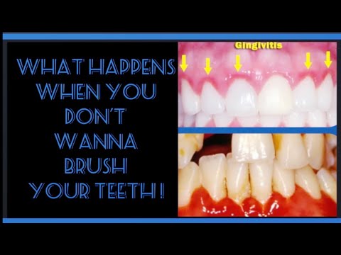 What Happens When You Don’t Brush Your teeth? - YouTube