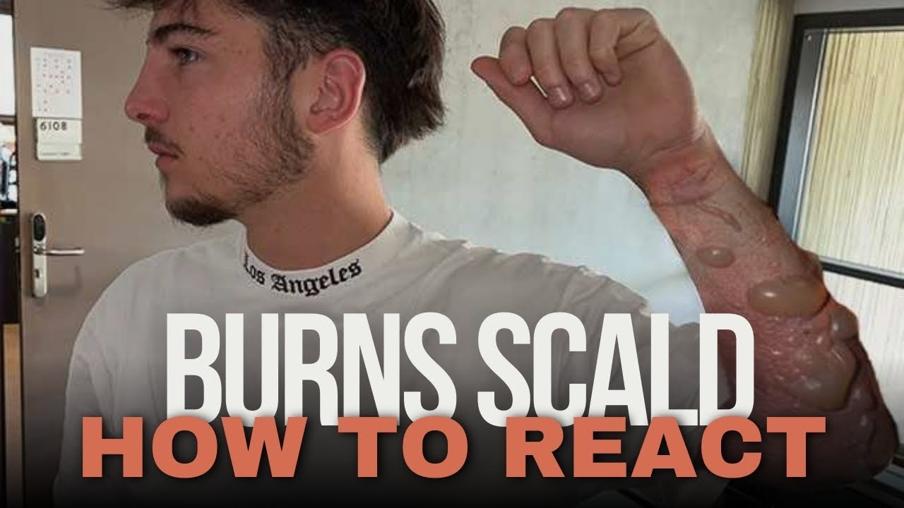 HOW TO REACT - BURNS SCALD - YouTube