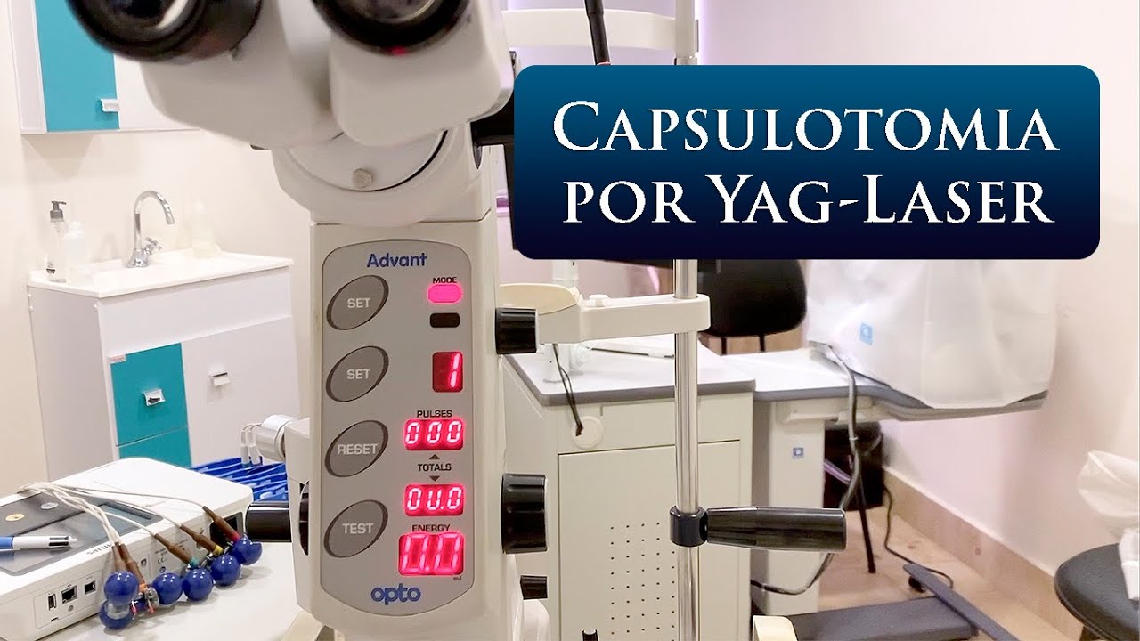 CAPSULOTOMIA POR YAG-LASER - YouTube