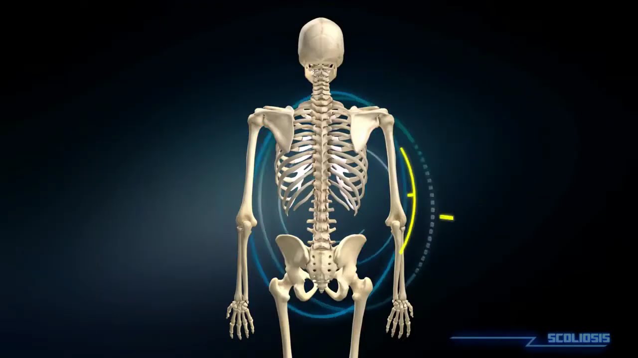 Watch Scoliosis 3D Animation Video - YouTube