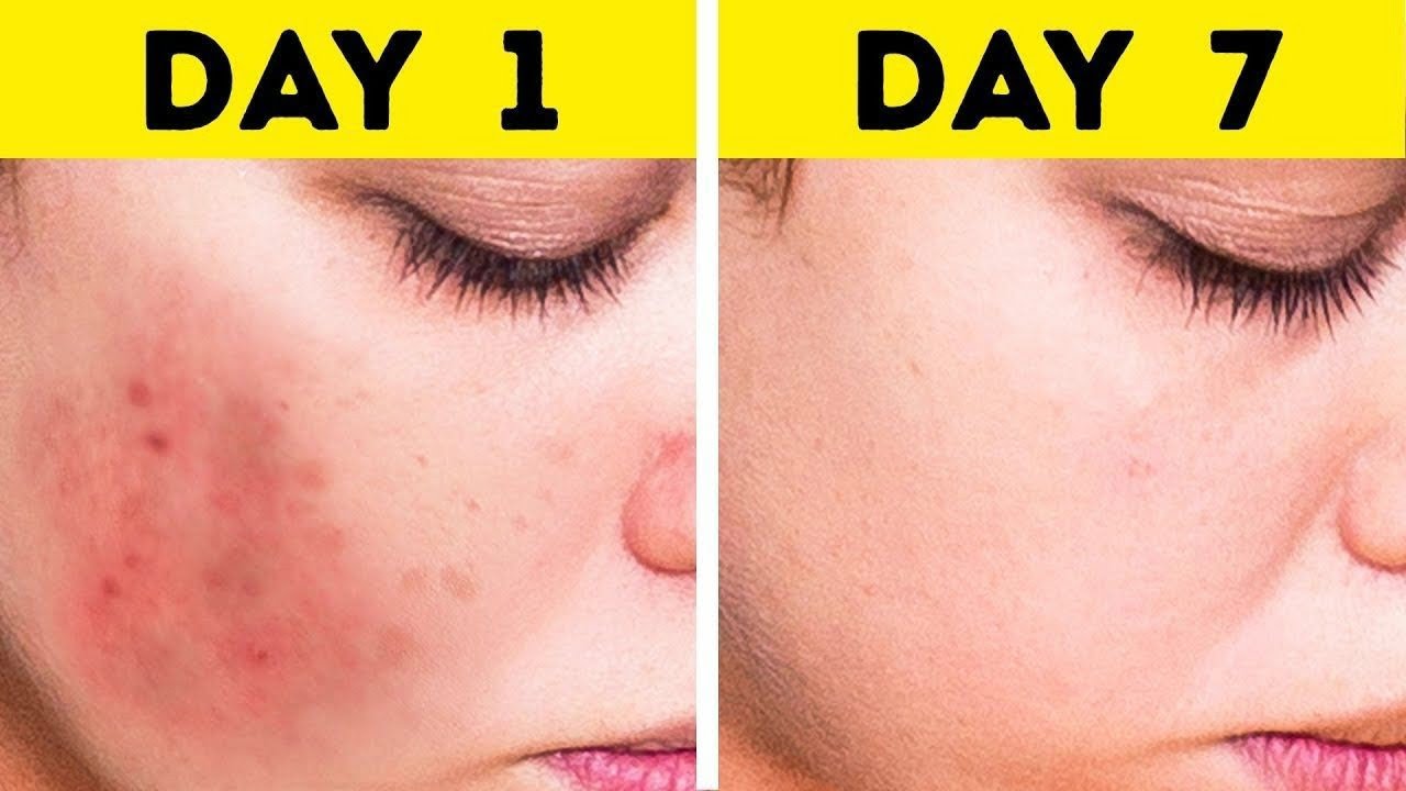 How To Get Rid Of Dark Spot On Face Just In Seven Days YouTube how-to-get-rid-of-dark-spot-on-face-just-in-seven-days-youtube