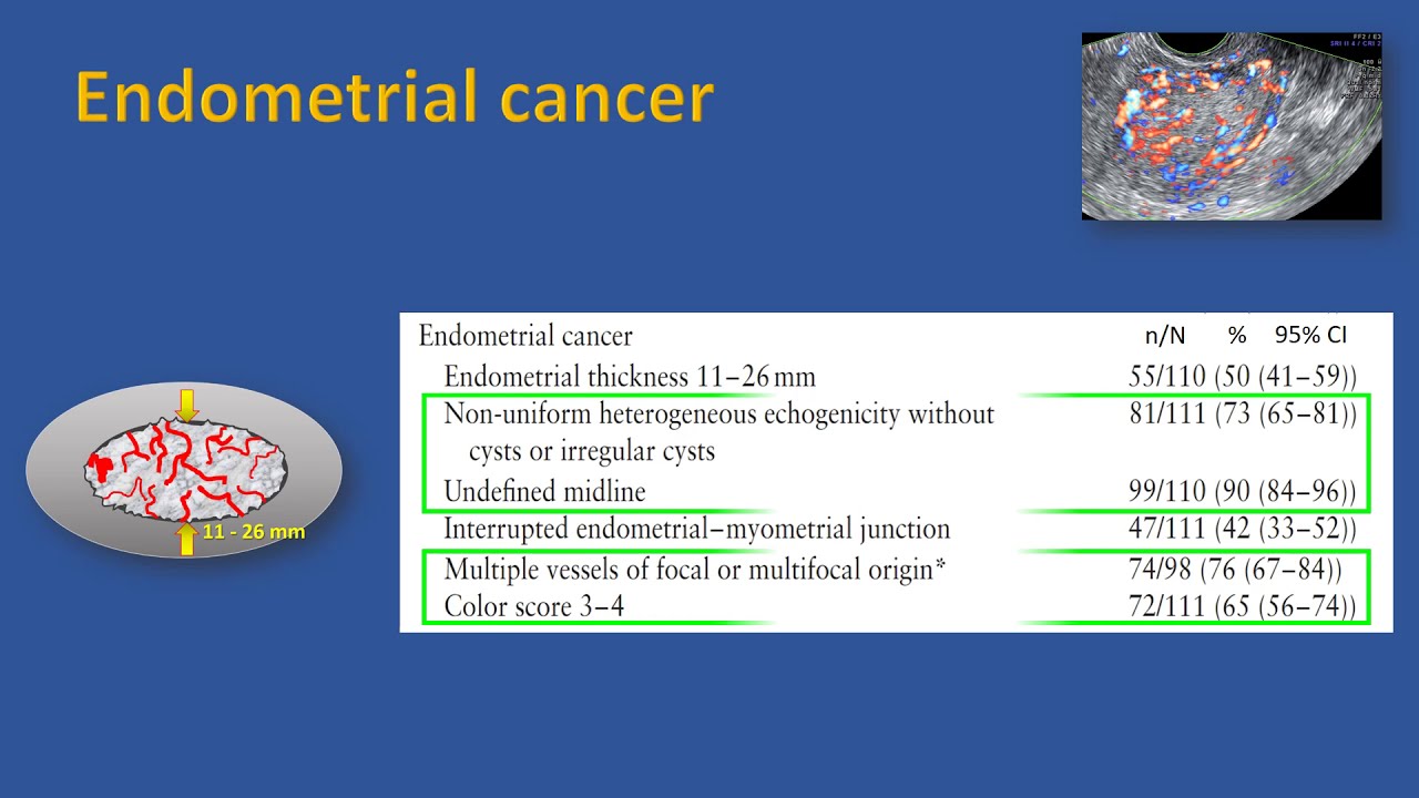 International Endometrial Tumor Analysis (IETA) terminology #UOGJournal ...